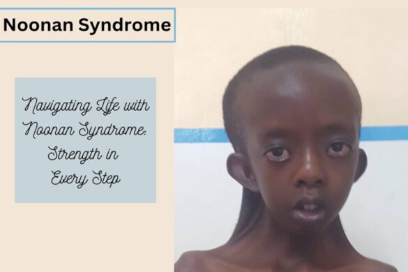 Celebrities With Noonan Syndrome: People Who Are Living With The ...